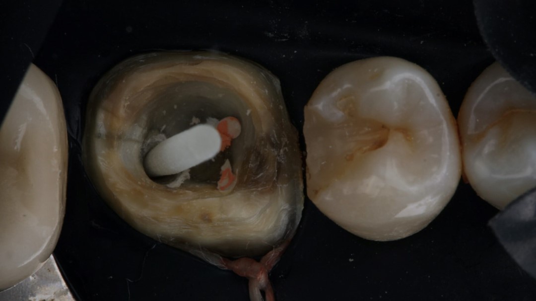 Cementation of fiber post, core buildup, and ceramic crown with the ...