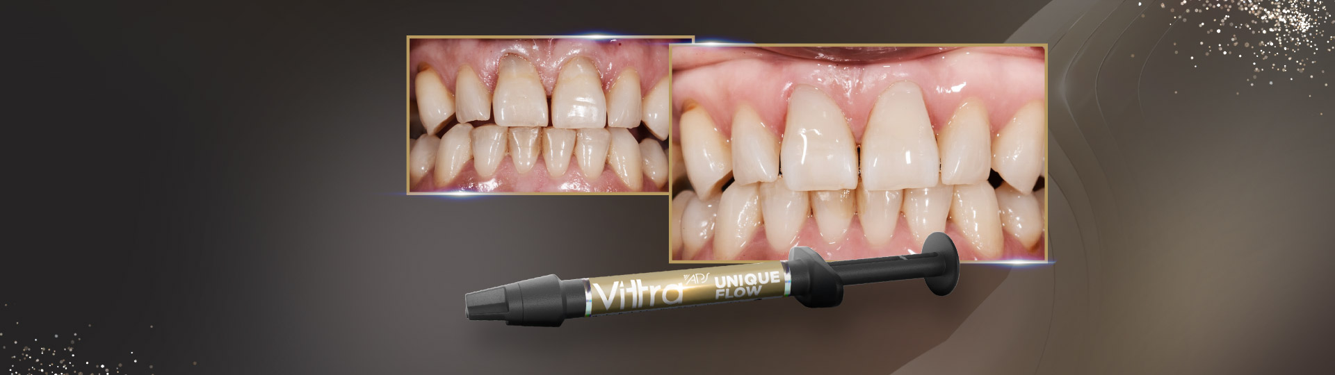Class V cervical lesion restored with Vittra APS Unique Flow ...