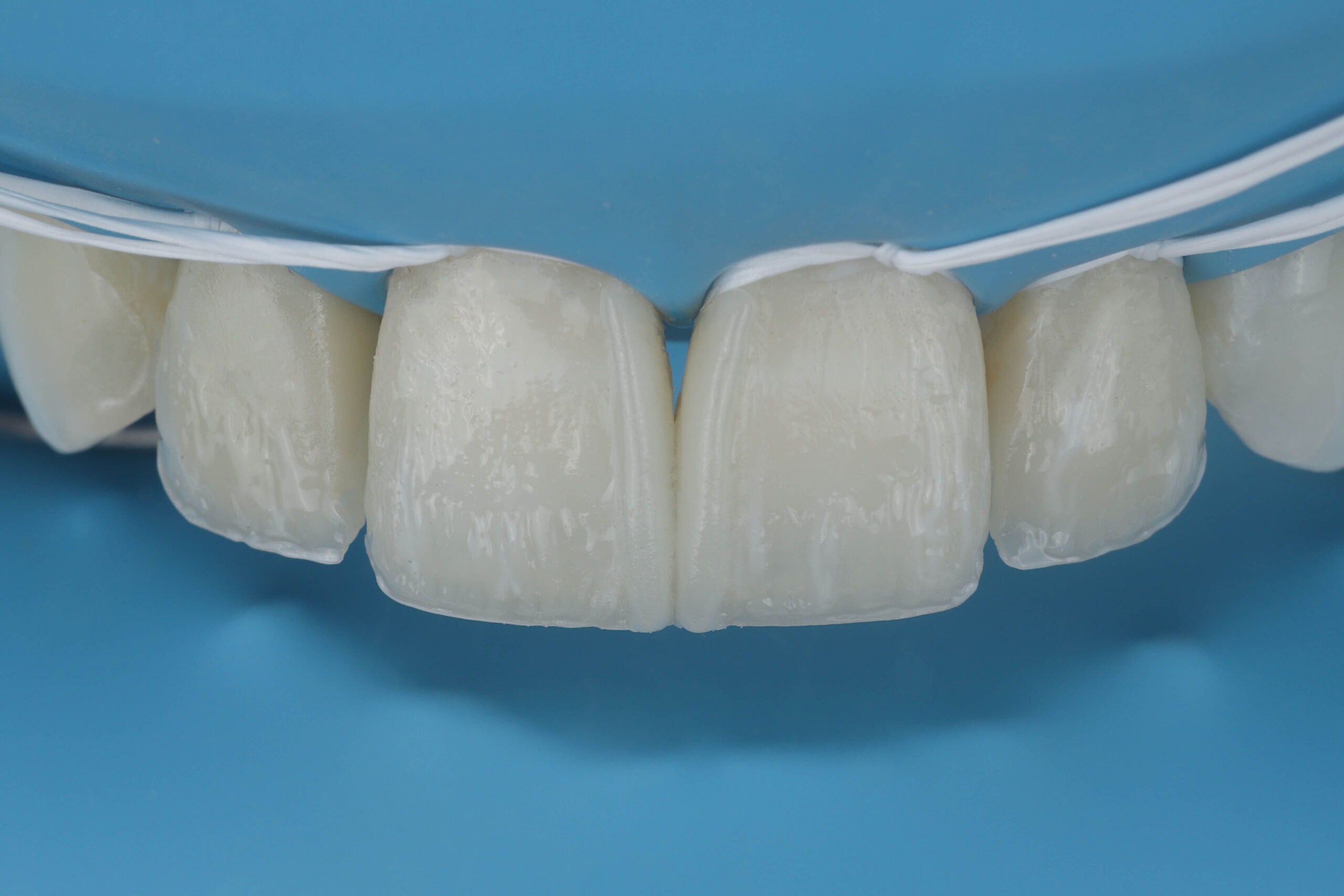 Facetas em resina composta direta - FGM Dental Group