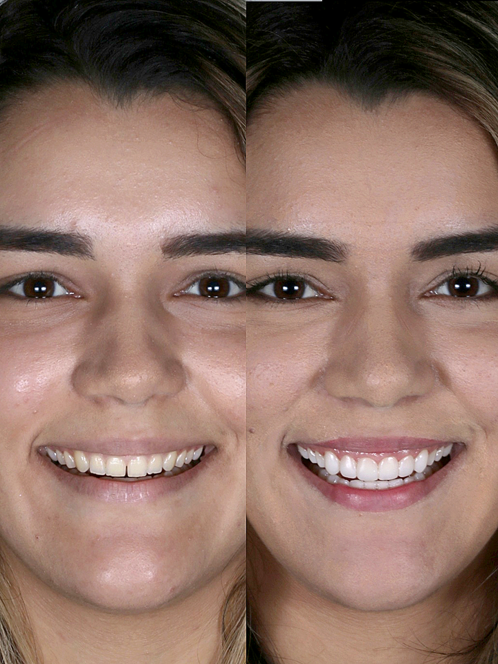 Facetas diretas em resina composta: funcionalidade e estética sem ...
