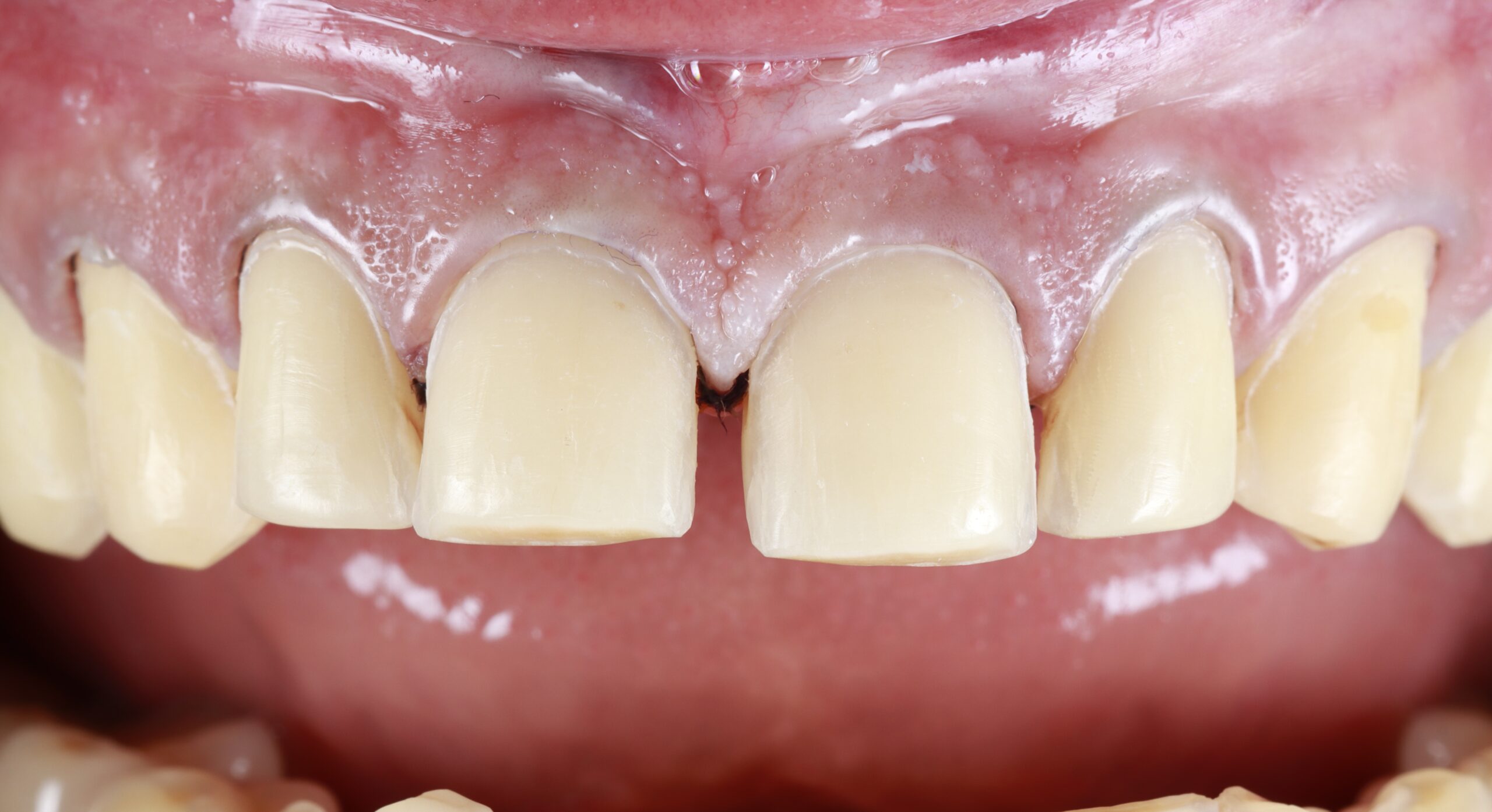 Facetas de Porcelana para Reabilitação Estética