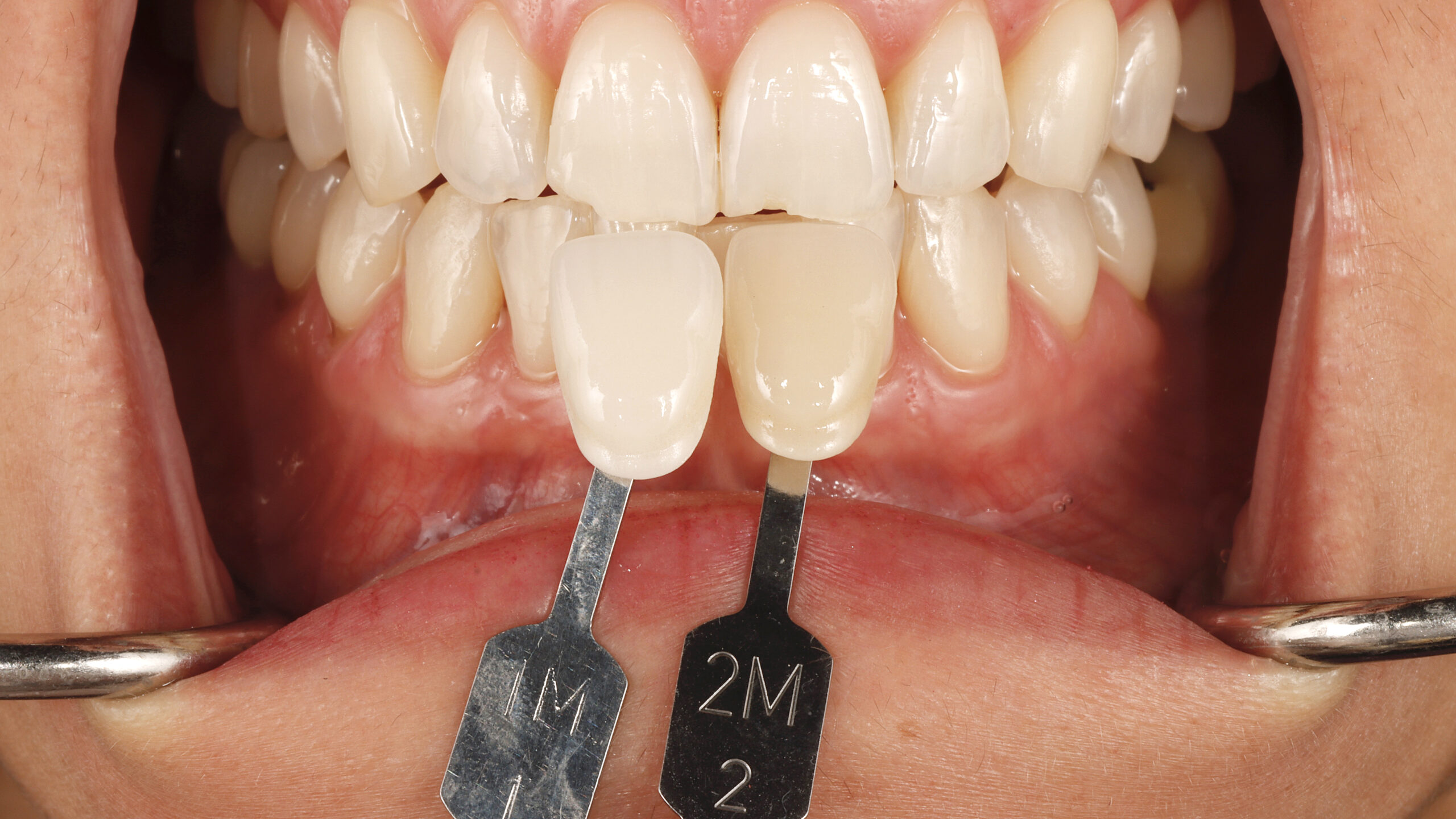 Whitening with Whiteness Perfect and restauration of incisal edges