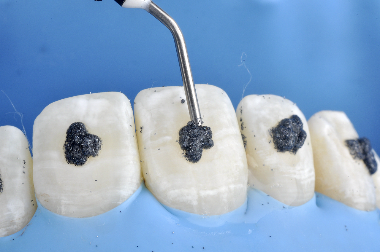 At-home whitening and microabrasion