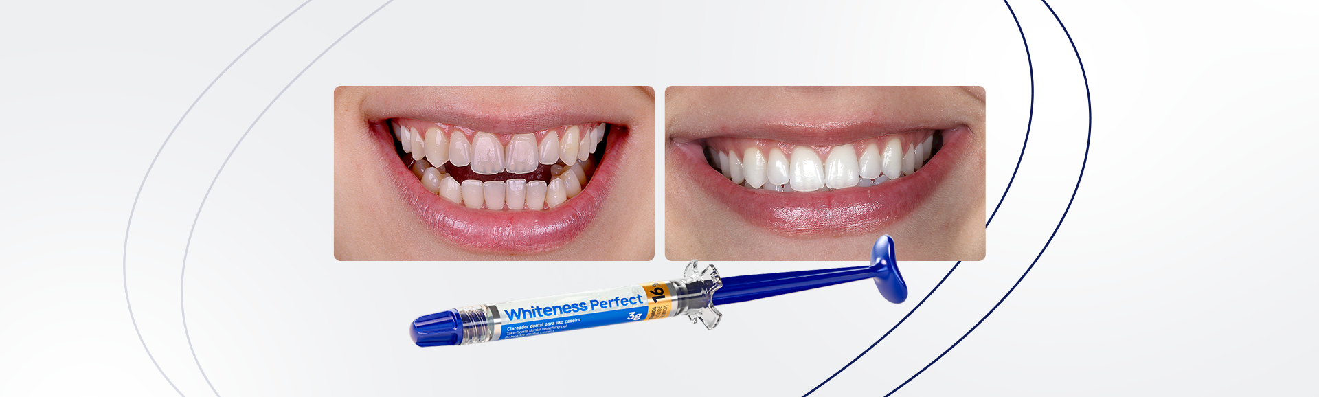 Técnica clareamento caseiro com Whiteness Perfect e White Class - FGM ...